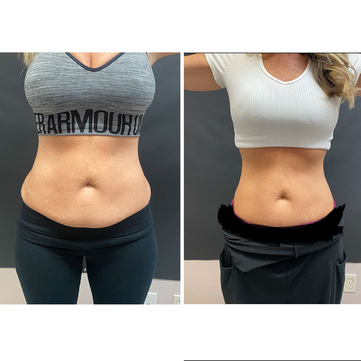 Cellulite and Fat Reduction & Body Contouring - Revivify Medical Spa