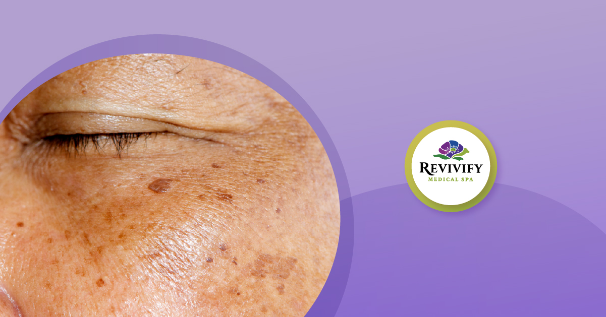 The Miami Peel® - Revivify Medical Spa