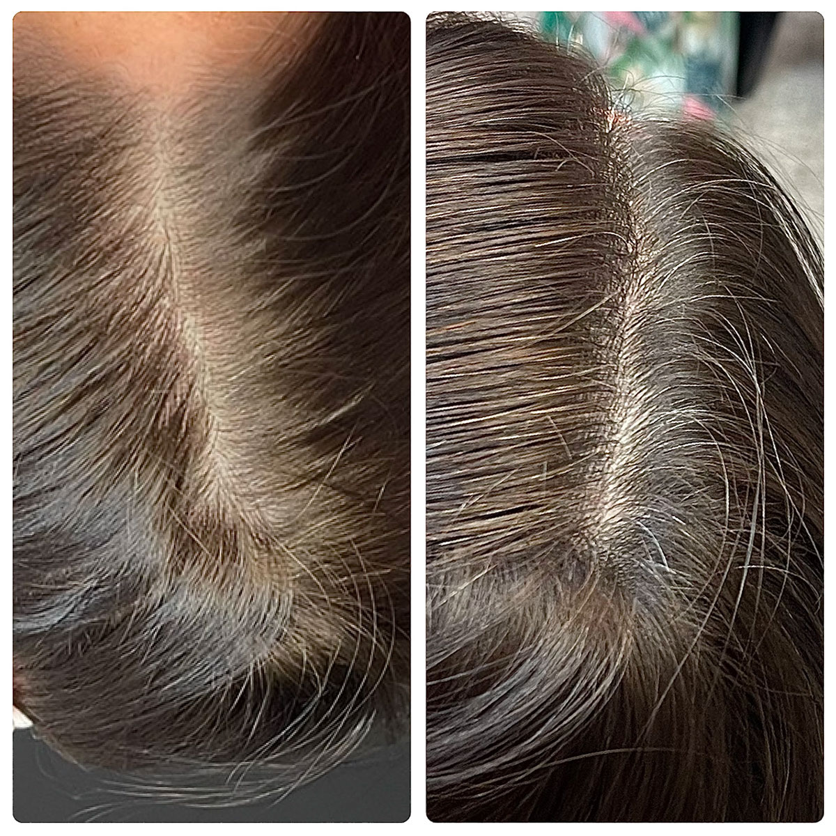 Hair Restoration Solutions That Work!